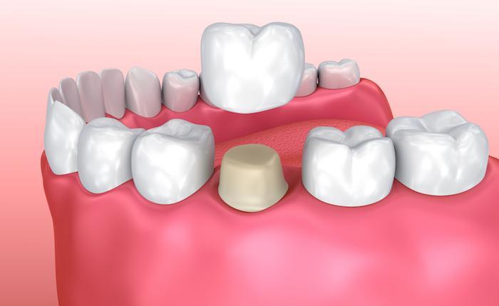 My Temporary Crown Hurts—Is This Normal or a Red Flag? - Dental Health ...