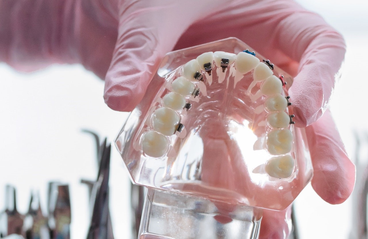Do Lingual Braces Affect Your Speech Dental Health Society
