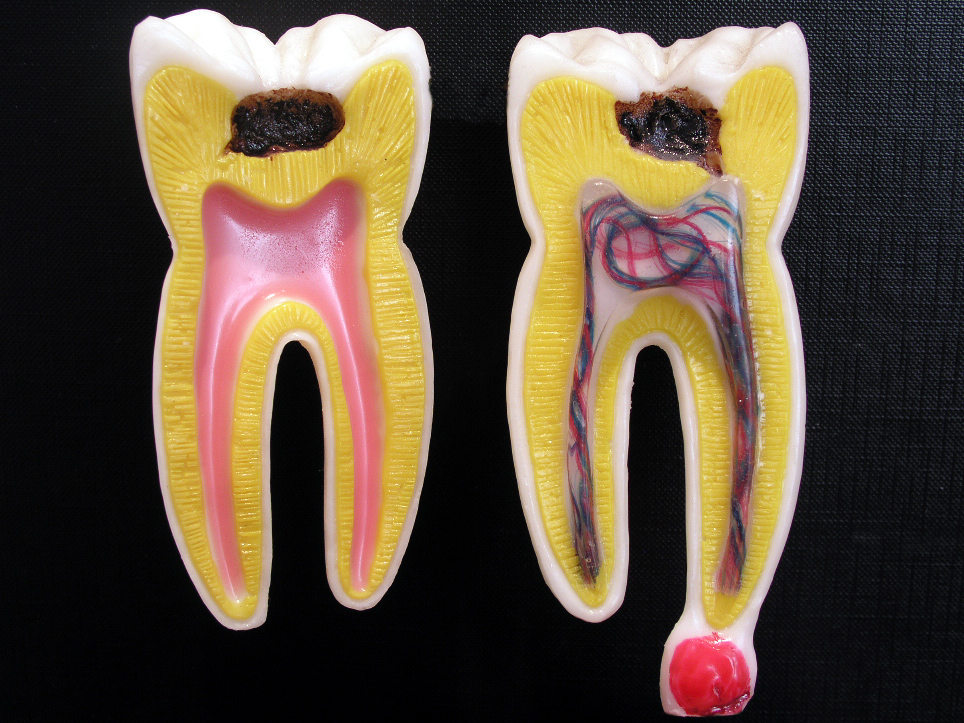 How Does Dental Pulp Get Infected Dental Health Society